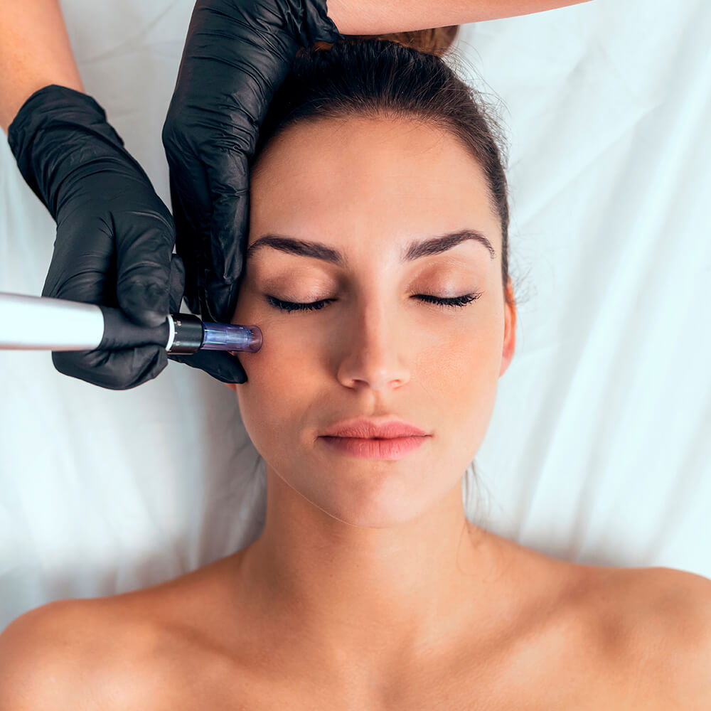 Experience Radiant Skin with Microneedling in Beverly Hills
