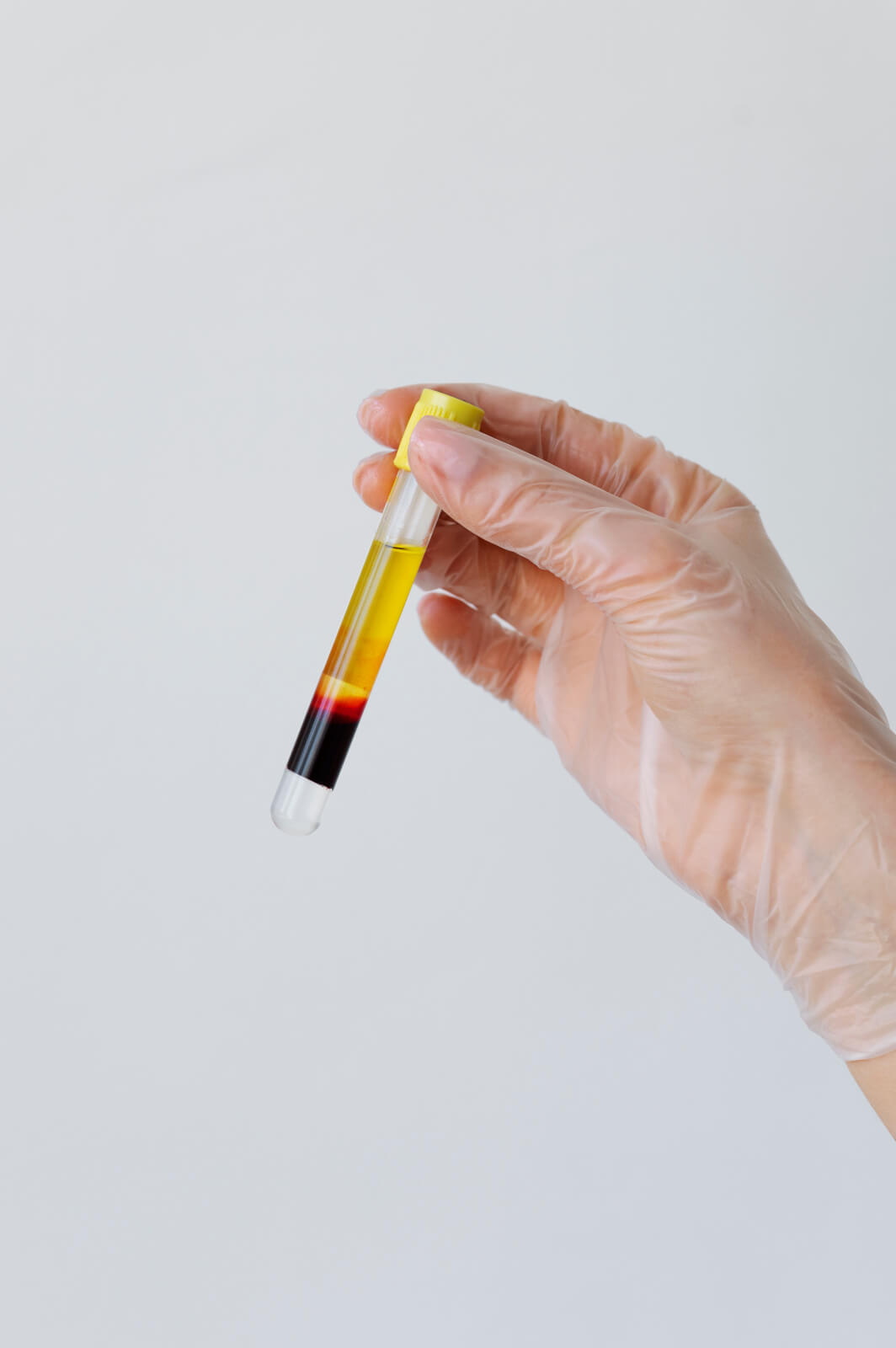 PRP Therapy – Rejuvenate Your Skin Naturally with Your Own Plasma ...